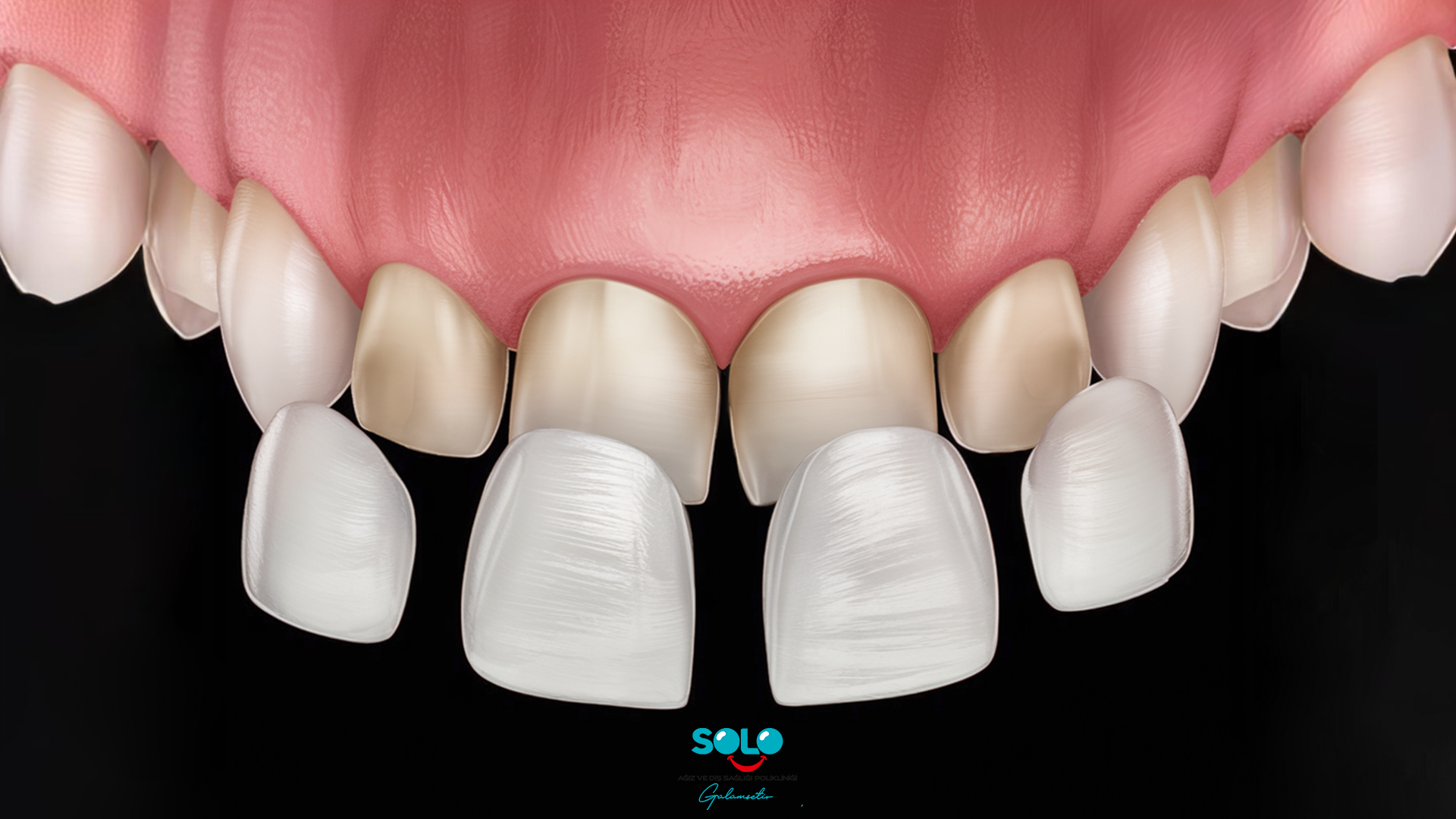 Laminated Teeth - Dent Solo - Diş Kliniği 2026