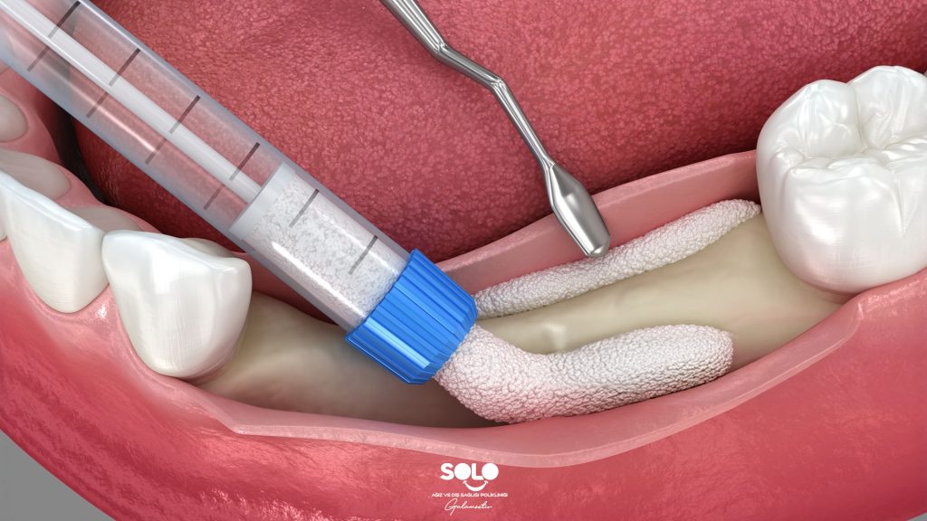 What Is Bone Grafting? - SoloDent 2025